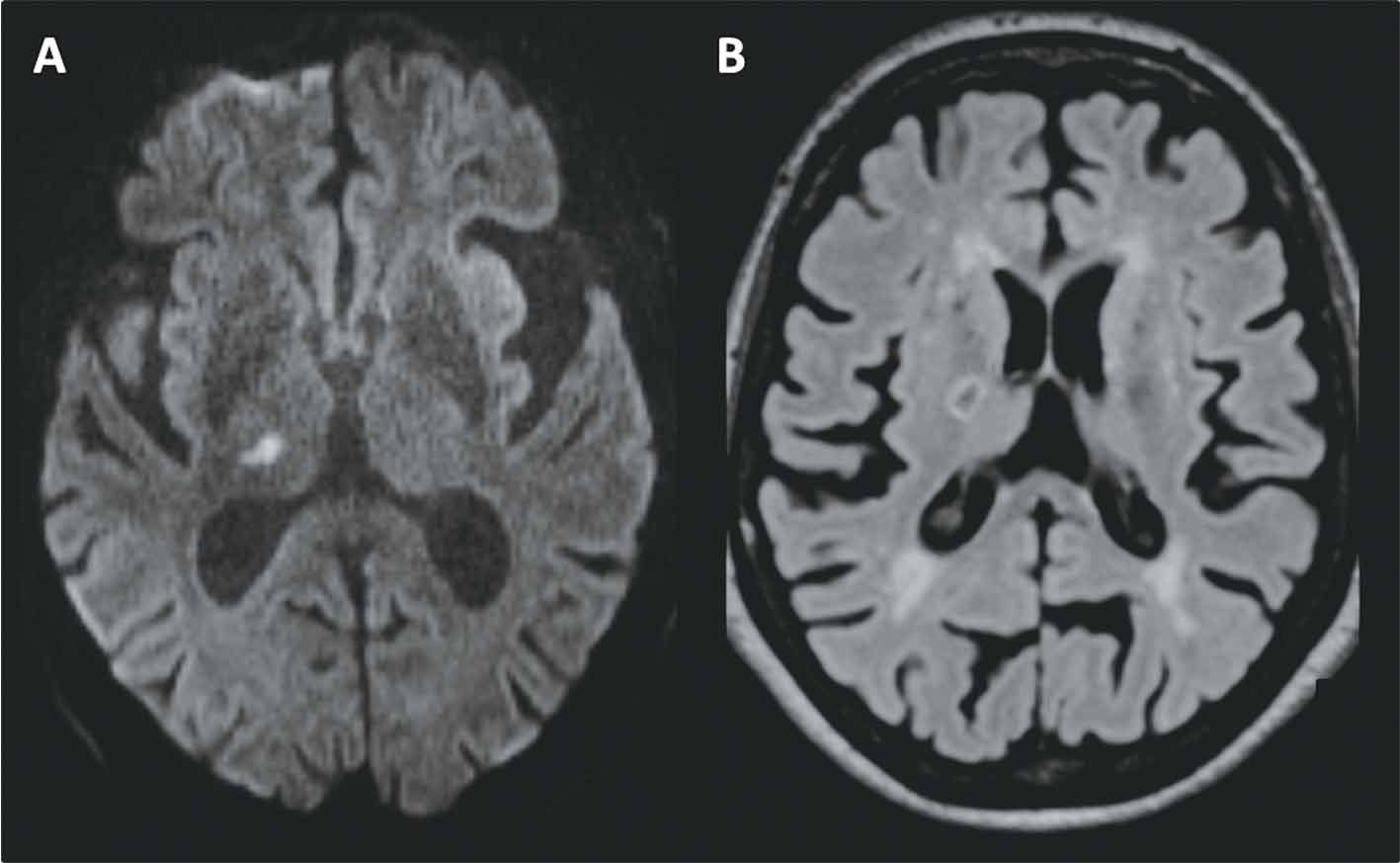 Les ESUS : concept, stratégie diagnostique et thérapeutique - Neurologies
