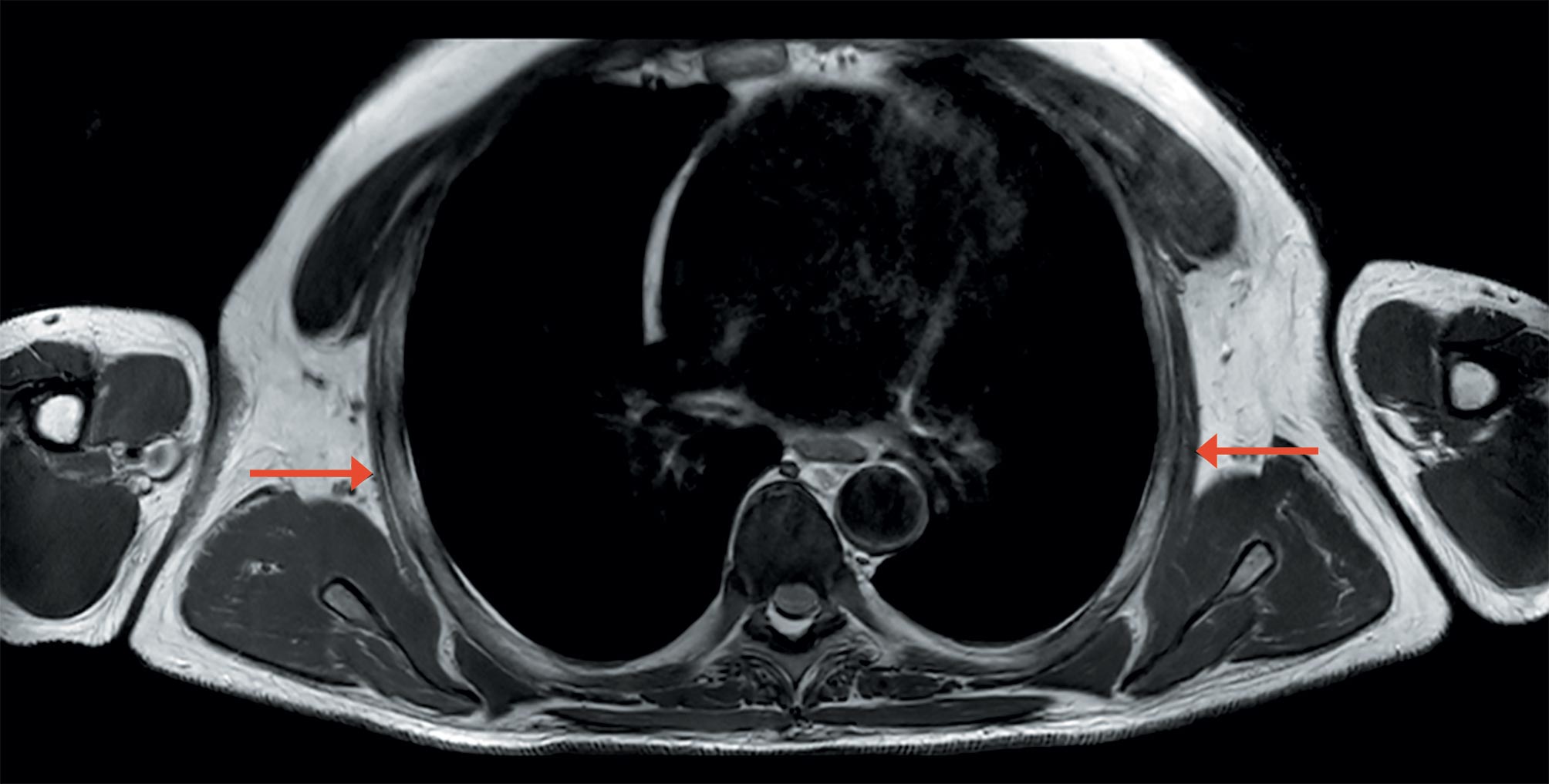 Le Parsonage-Turner est-il toujours un diagnostic facile ? - Neurologies