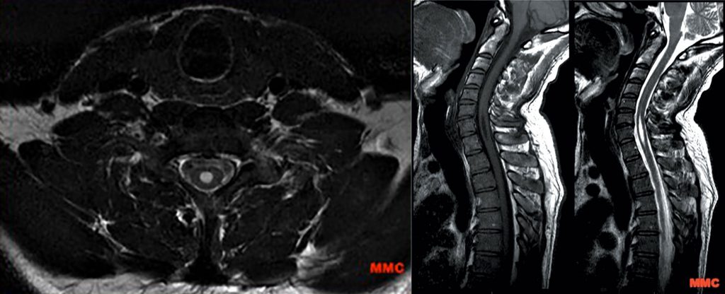 La syringomyélie : voyage au centre de la moelle... - Neurologies