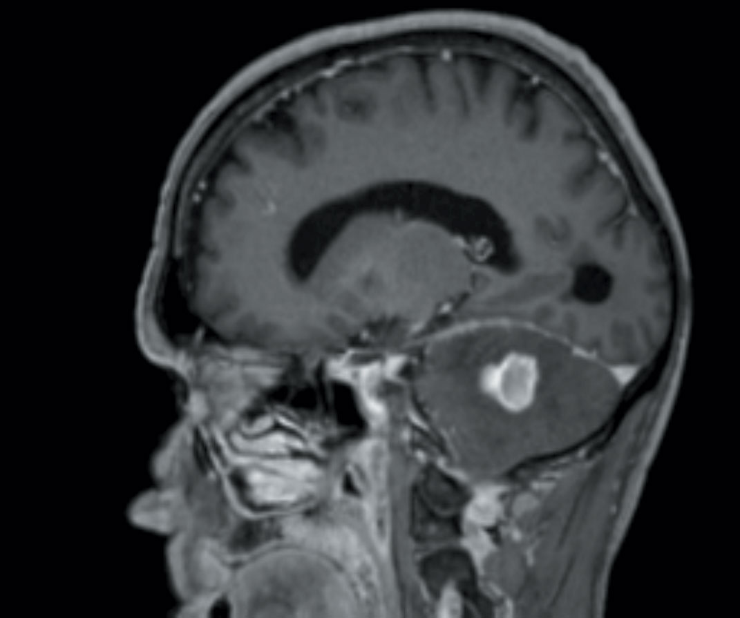 Métastases cérébrales : critères décisionnels du traitement local dans ...