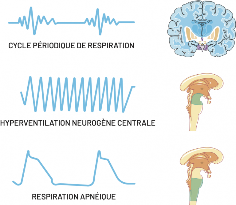 Troubles de la conscience et coma - Neurologies