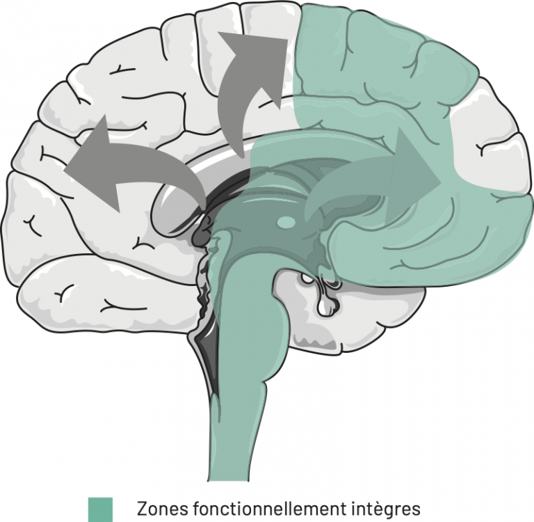 Troubles de la conscience et coma - Neurologies