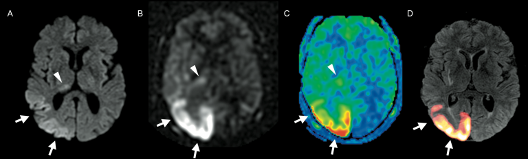 Première crise épileptique et IRM : les progrès de l’IRM anatomique et ...