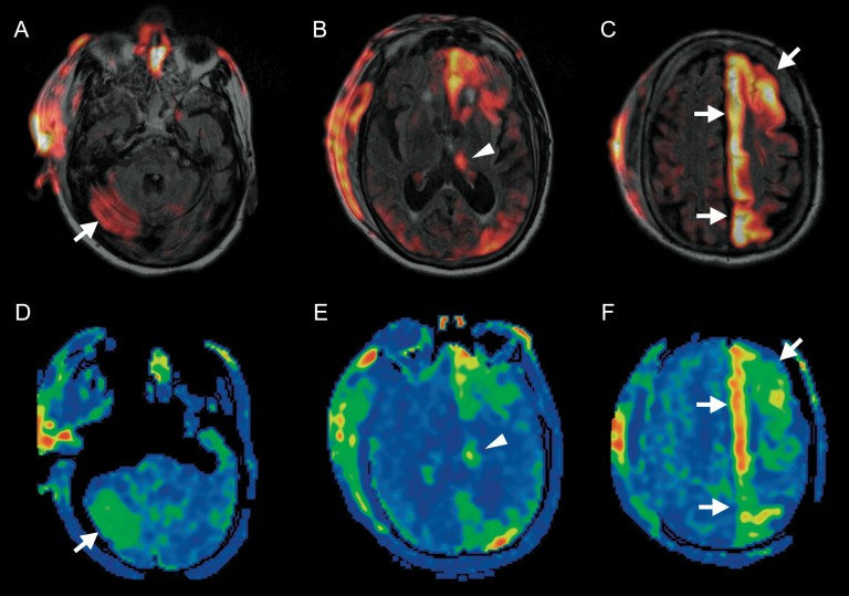 Première crise épileptique et IRM : les progrès de l’IRM anatomique et ...