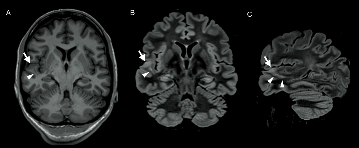 Première crise épileptique et IRM : les progrès de l’IRM anatomique et ...