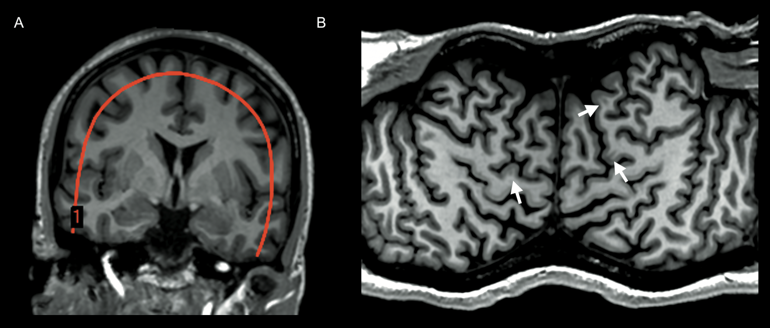Première crise épileptique et IRM : les progrès de l’IRM anatomique et ...