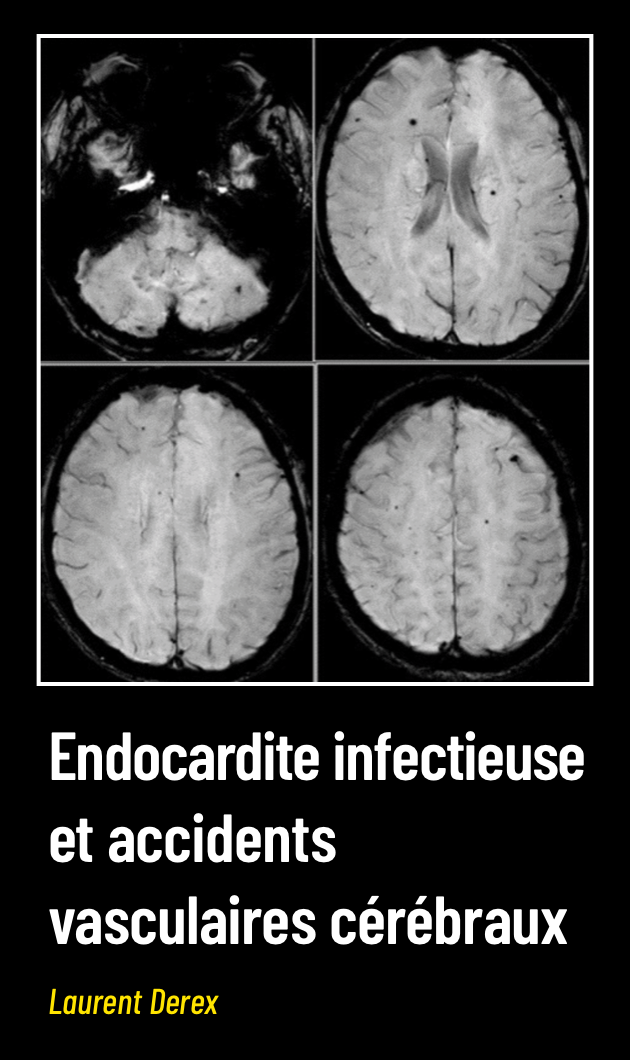 Endocardite infectieuse et accidents vasculaires cérébraux - Neurologies