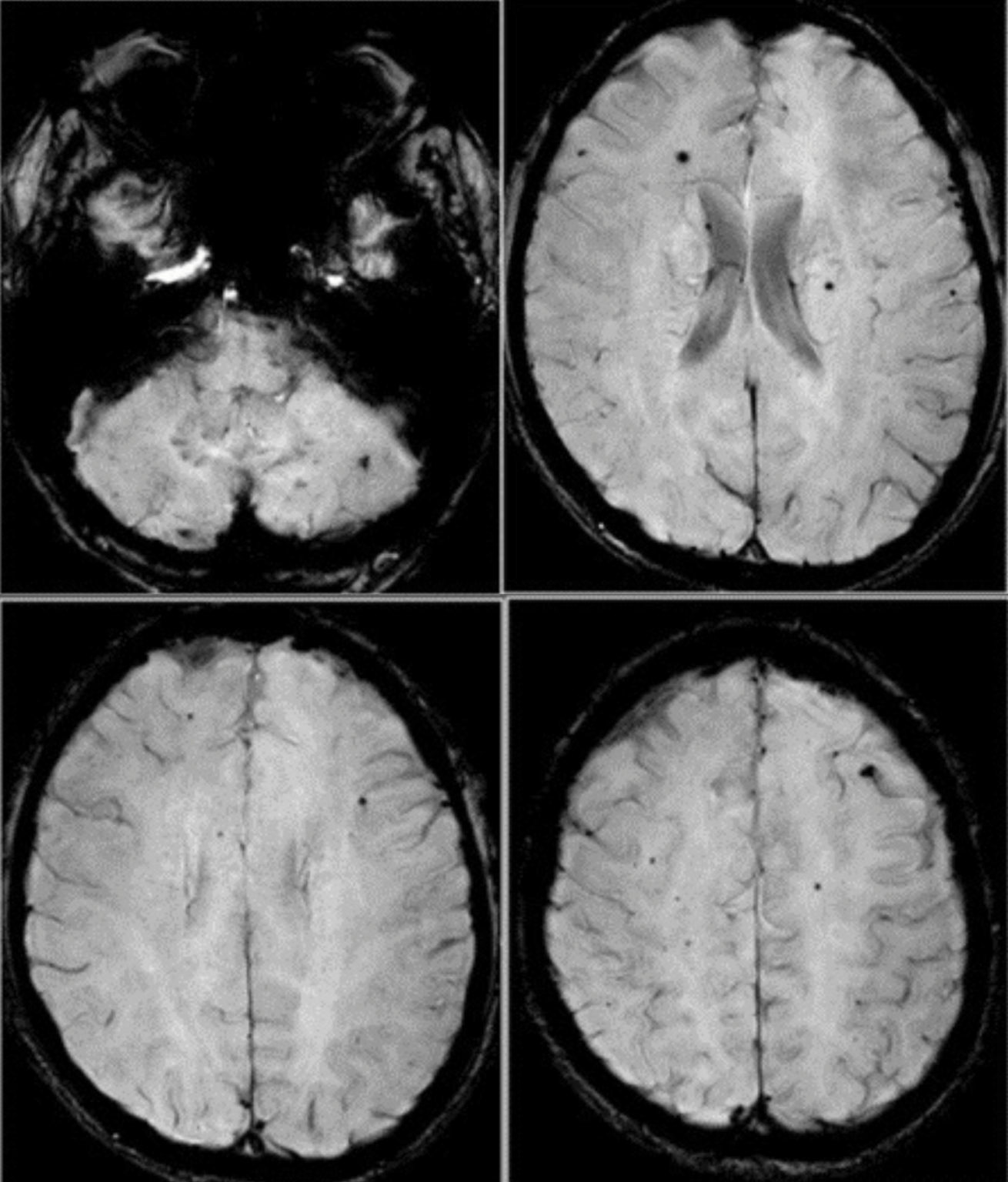 Endocardite infectieuse et accidents vasculaires cérébraux - Neurologies