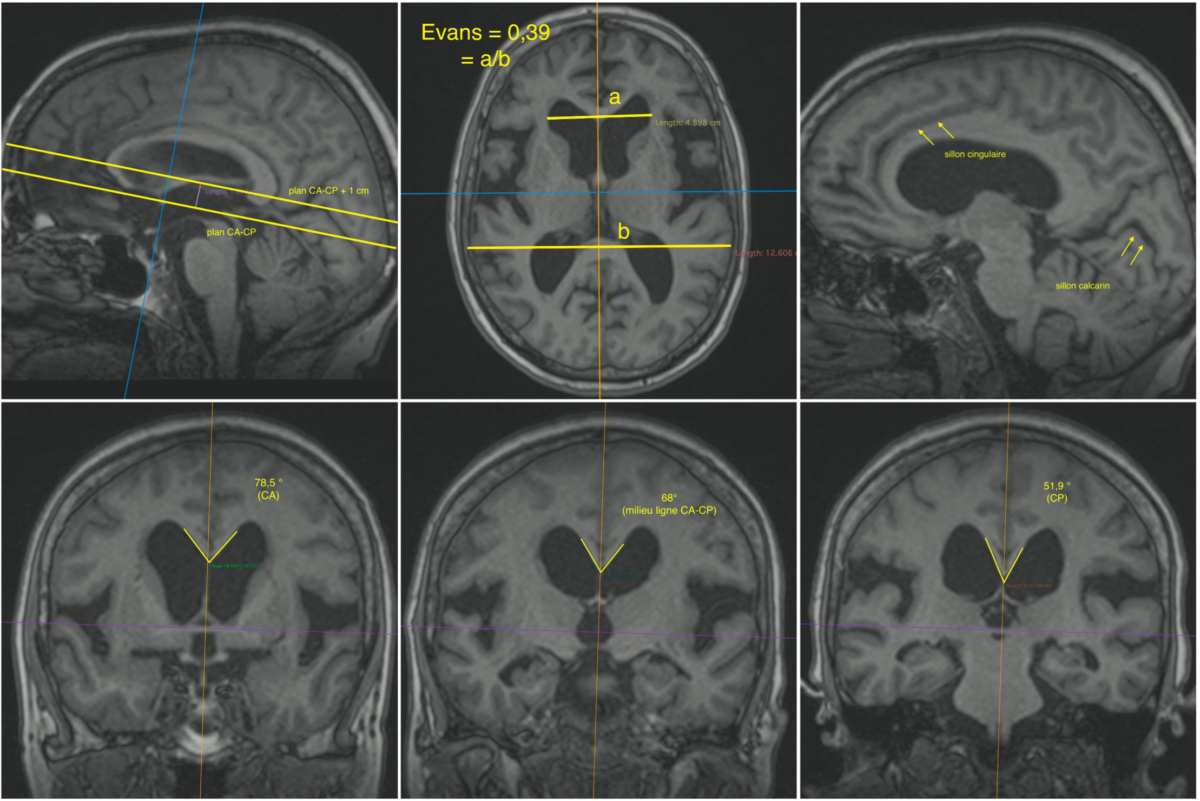 L’hydrocéphalie chronique de l’adulte, ou hydrocéphalie « à pression ...