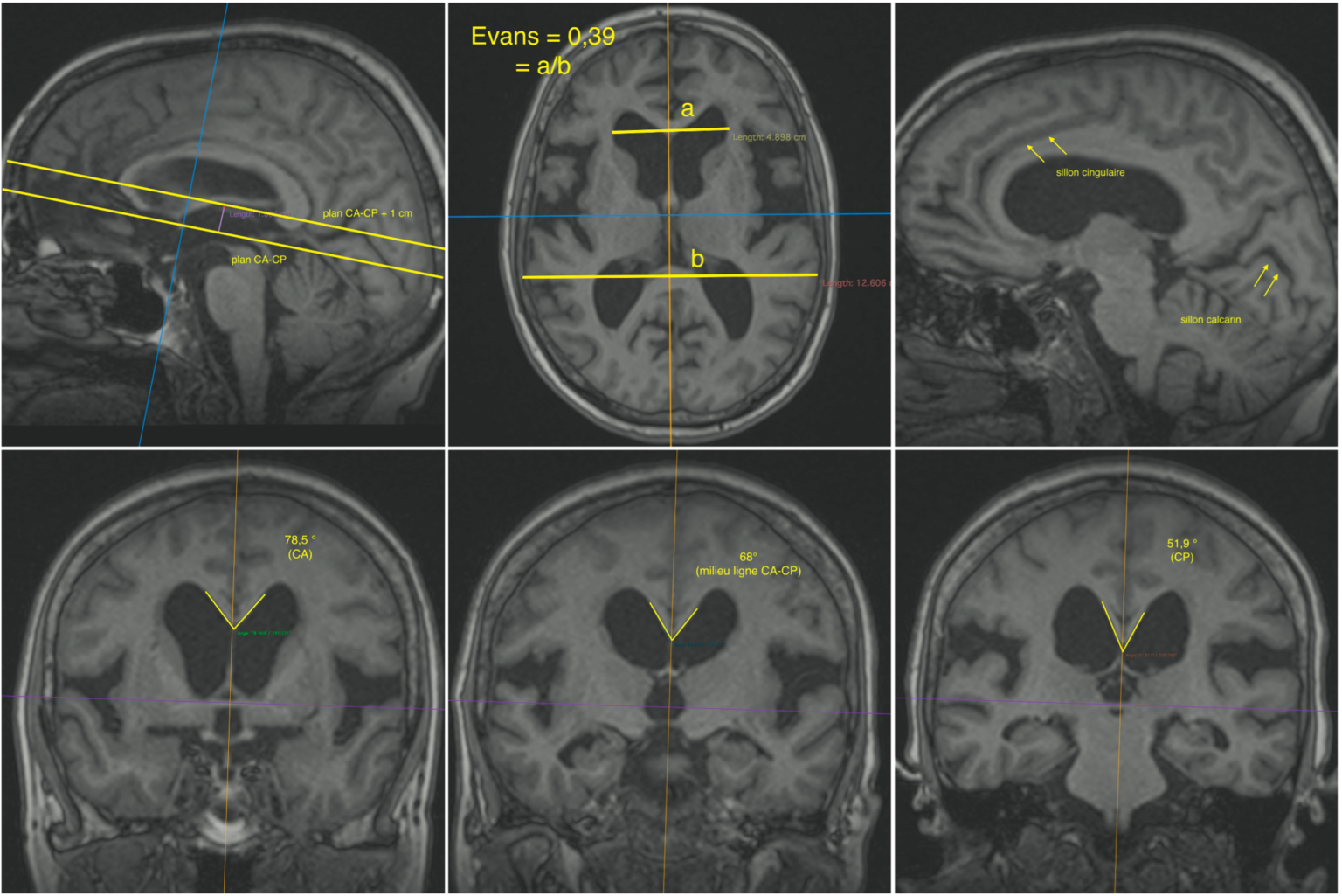 L’hydrocéphalie chronique de l’adulte, ou hydrocéphalie « à pression ...