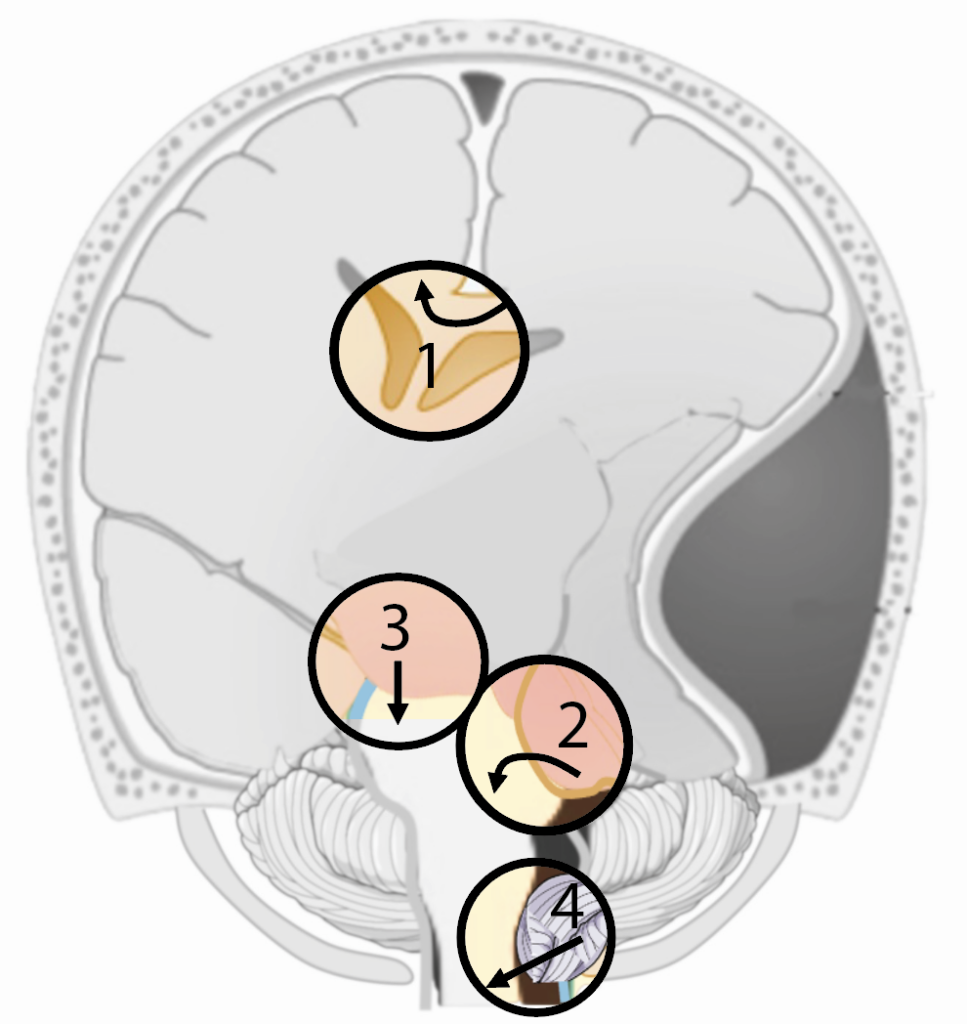 Traumatismes crâniens modérés et graves - Neurologies