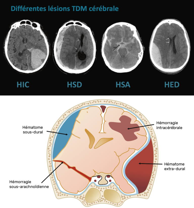 Traumatismes crâniens modérés et graves - Neurologies
