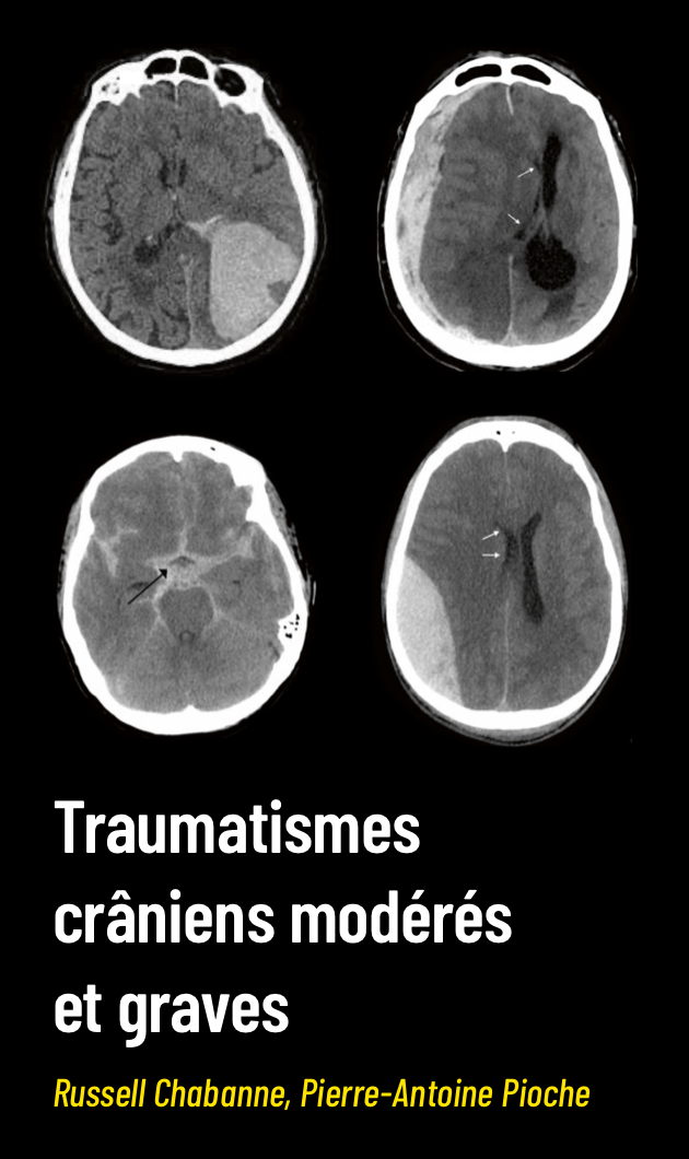 Traumatismes crâniens modérés et graves - Neurologies
